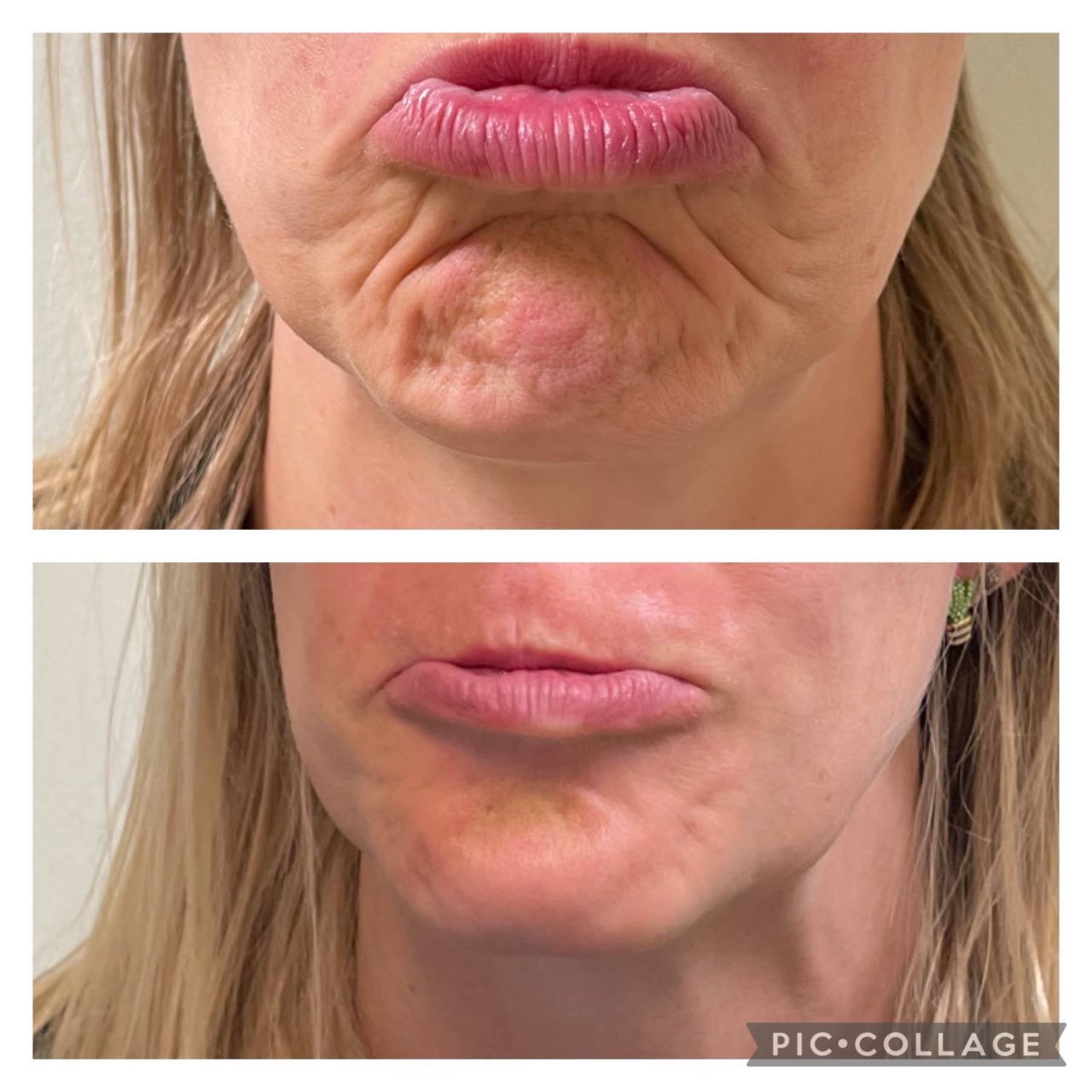 Procedures - Rachel Dahlen, RN Cosmetic Nurse